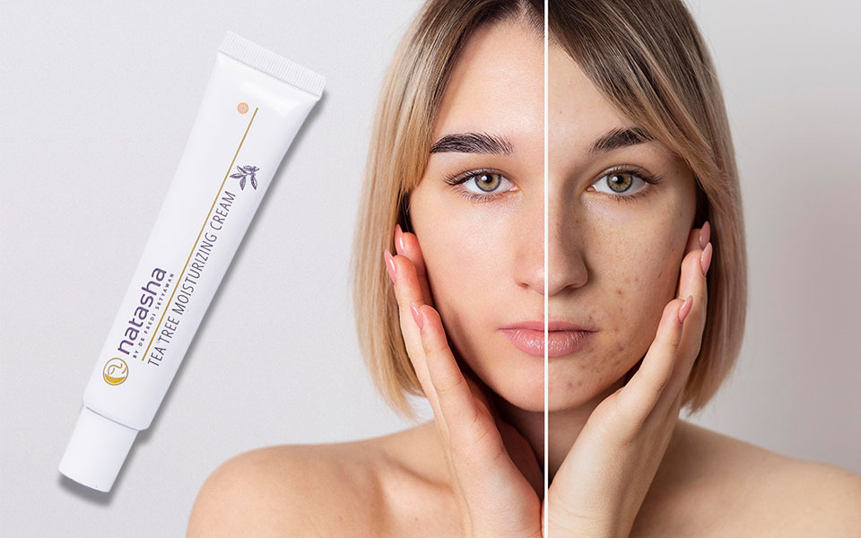 Mengatasi Jerawat Tanpa Ribet – Natasha Skin Clinic Center